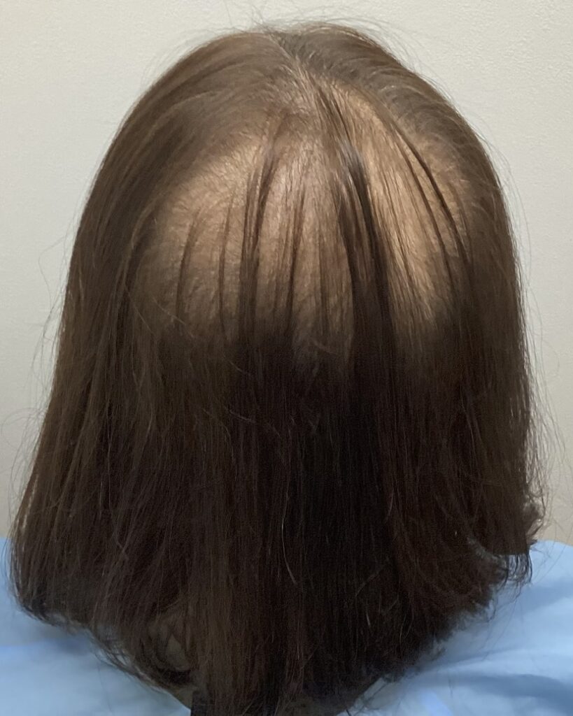 FAGAとは？女性の薄毛原因と治療法を医師が解説 - 女性の薄毛治療専門クリニック | ルートレディースAGAクリニック