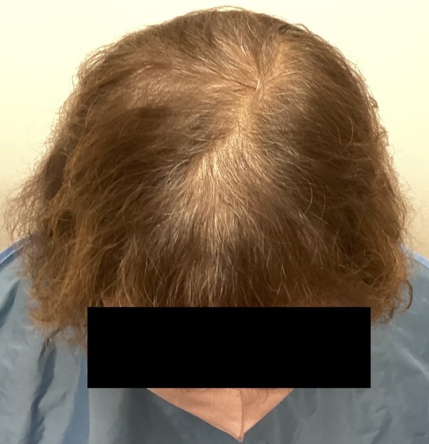 女性の分け目はげ原因8つと改善策【医師執筆】すぐできる対策も - 女性の薄毛治療専門クリニック | ルートレディースAGAクリニック